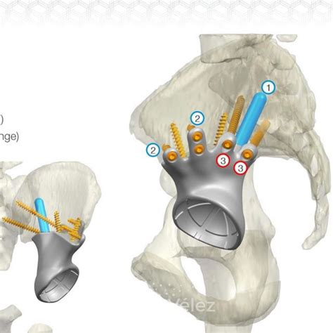 Sarcoma Epitelioide Pélvico Dr Roberto