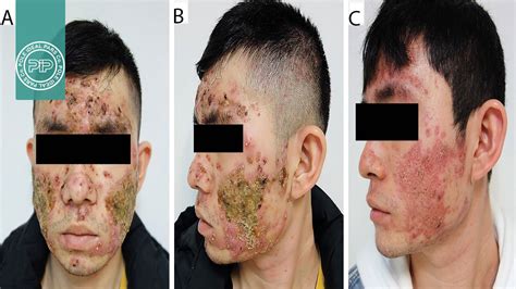 مطالعه موردی بررسی بیمار مبتلا به آکنه فولمینانس مجله پل ایده‌آل پارس