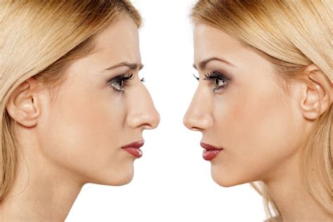 How Long Does The Rhinoplasty Procedure Last Finest Ego