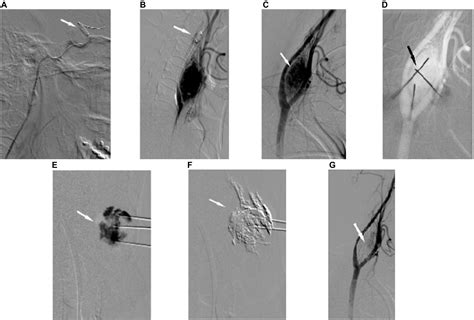 Preoperative Percutaneous Onyx Embolization Of Carotid Body