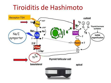 Jose Luis Vasallo Monteso On Linkedin Tiroiditis De Hashimoto