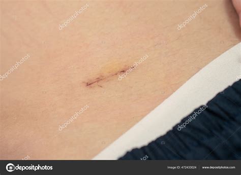 Fresh Appendix Surgical Wound Suture Removal Appendectomy Surgery