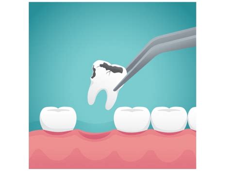 4 Things To Know Before Getting A Tooth Extraction