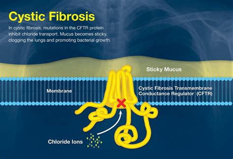 Visual Explanation Of How Cystic Fibrosis Affects The Lungs Woods