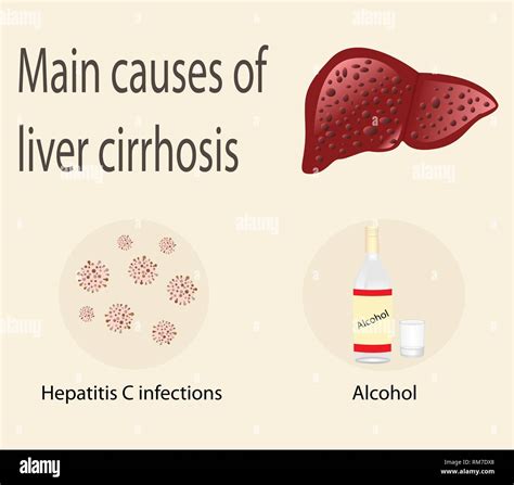 Main Causes Of Liver Cirrhosis Hepatitis C Infection And Alcohol Vector