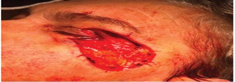 Dermatologic Surgery