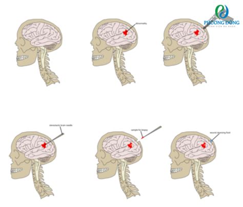 Sinh thiết não là gì và quy trình thực hiện sinh thiết não