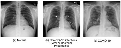 Information Free Full Text A Robust Hybrid Deep Convolutional Neural Network For COVID