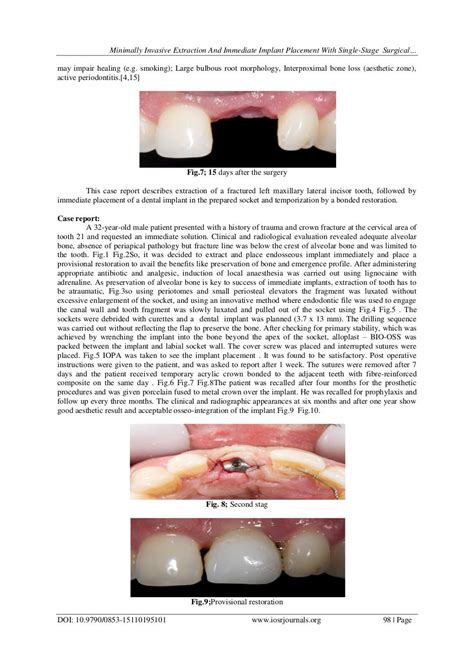 Minimally Invasive Extraction And Immediate Implant Placement With Si