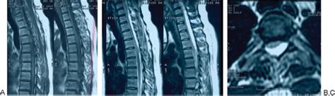 A T1 Weighted Sagittal Magnetic Resonance MR Images Of Thoracic