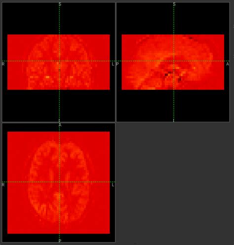 Arterial Spin Labelling Tutorial — Quantiphyse Documentation