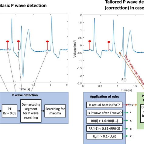 an example of the p wave detection procedure and the application of