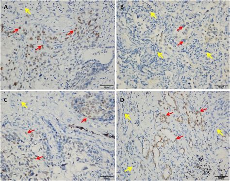 Immunohistochemical Analysis Of Hiv Associated Lung Tumor Tissue