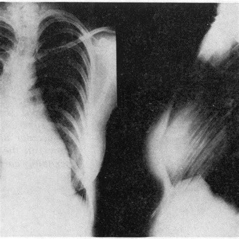 Aortogram Showing Fusiform Dilation Of The Ascending Aorta Which Is