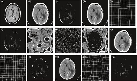 brain image multimodality registration result a mri reference image