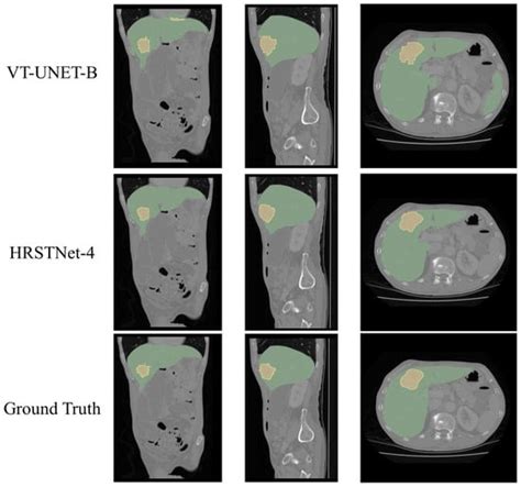 High Resolution Swin Transformer For Automatic Medical Image Segmentation