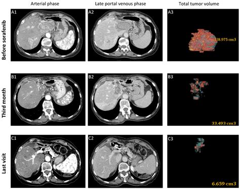 Baseline Ct Scan A1a2 Showing The Large Hcc Mass Maximum Diameter