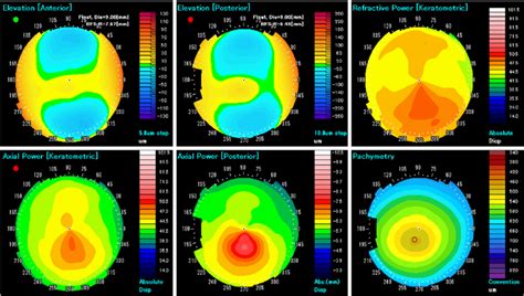Representative Example Of 6 Color Coded Maps Anterior Elevation