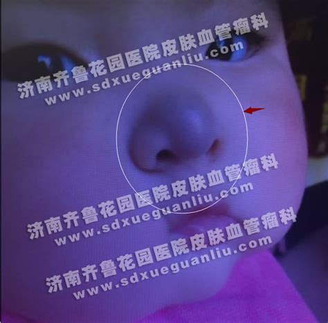 鼻子上血管瘤图片 管的症状图片 眼睛长了管图片 大山谷图库