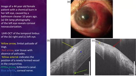 Anterior Segment And Corneal Oct Review Ppsx