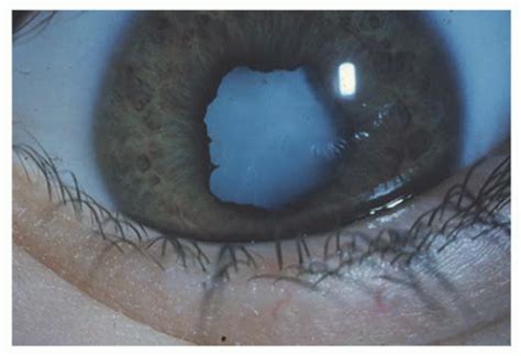 Pediatric Uveitis Ento Key