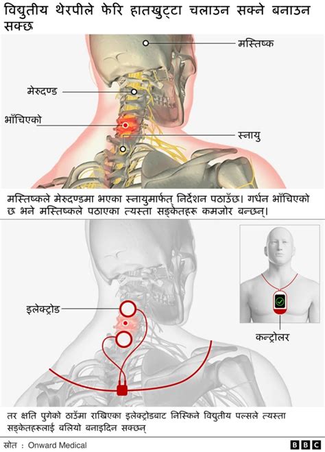 मेरुदण्डमा चोट लागेर पक्षाघात भएका बिरामीलाई विद्युतीय पल्स ले कसरी
