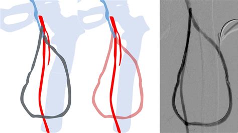 Case 98 Thrombosed Arterio Venous Loop Graft Ir 4 U