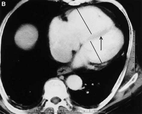 Transverse Contrast Enhanced Ctpa In A 69 Year Old Man With Pulmonary Download Scientific