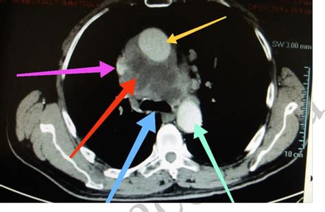 Figure From Cervical Plexus Block Safe Anesthesia For The Patients With Massive Mediastinal