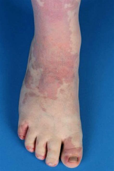 Compva Capillary Malformations
