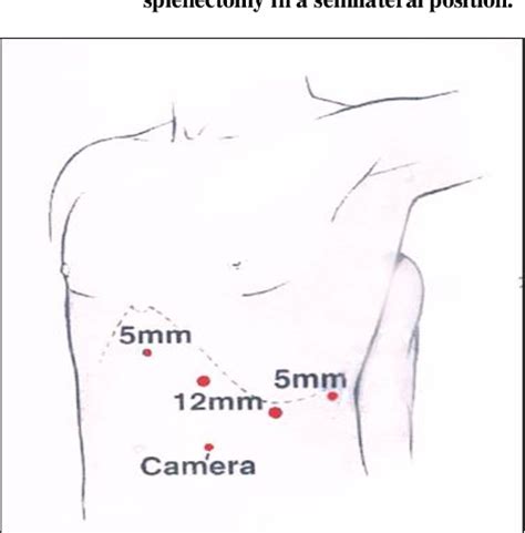 Table 1 From Laparoscopic Splenectomy Postero Lateral Approach