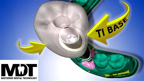Ti Base Implant Crown Design With Exocad [ Model Creator Bonus Implant