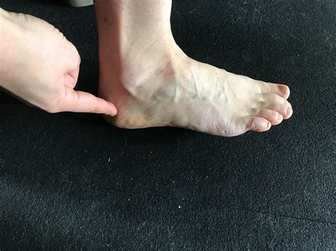 Bone Stress Injuries In Runners Part 1 — Endurance Physio Missoula Physical Therapy