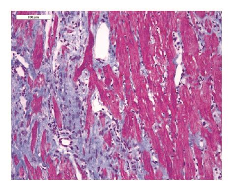 The Effect Of SFI Treatment On Left Ventricular Myocardial Fibrosis In