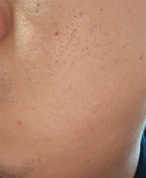 얼굴에 여드름 인가요 지식in