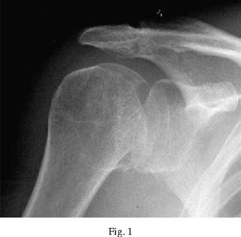 Proximal Humerus Fractures Trauma Orthobullets 42 OFF