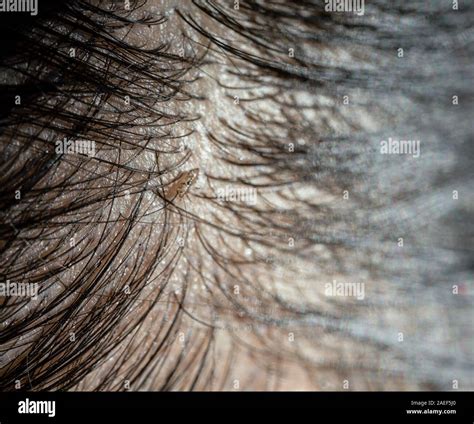 Head Lice And Eggs At Emil Bentley Blog