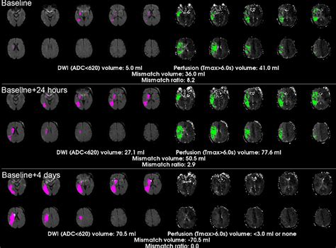 Persistent Target Mismatch Profile 24 Hours After Stroke Onset In Defuse 3 Stroke