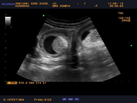Shrivari Sono Scans Small Bowel Intussusception Secondary To Inflammatory Fibroid Polyp Of The