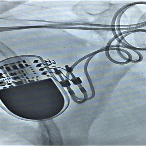 Pdf Pacemaker Malfunction Disengagement Of Lead Pin From Connector