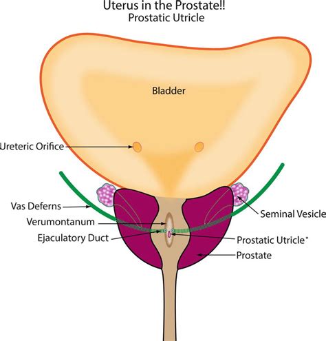 Prostatic Utricle