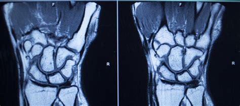 Hand And Wrist Mri I Med Radiology Network
