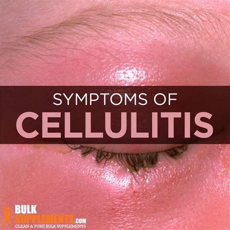 Cellulitis Causes