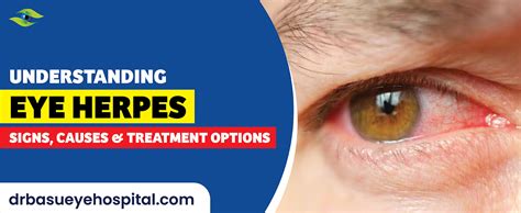 Understanding Eye Herpes Signs Causes And Treatment Options