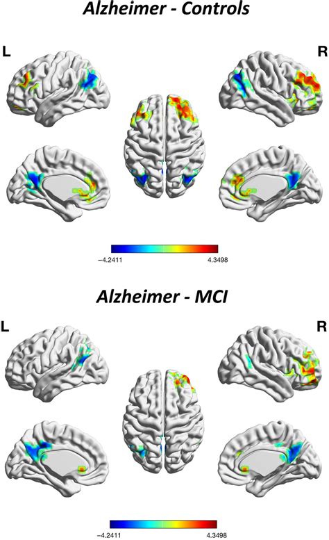 Whole‐brain Voxel‐level Secondary Gradient Comparisons Among The Download Scientific Diagram