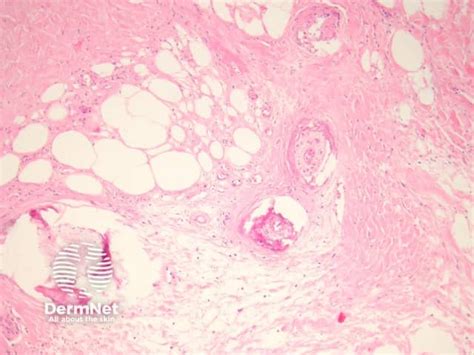 Calciphylaxis Pathology