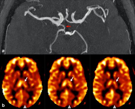 Case Of A Woman In Her Late Seventies Presenting For Follow Up Of A