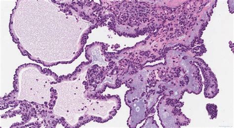 Mesothelioma Atlas Of Pathology