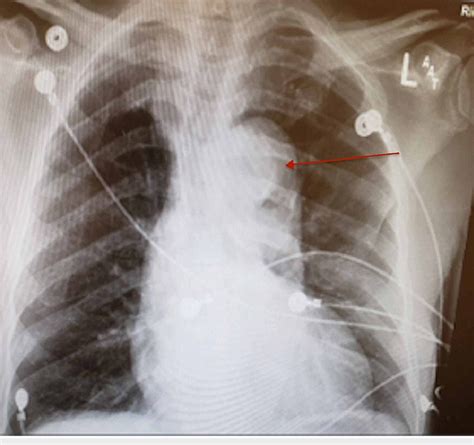 Chest X Ray Mediastinal Widening With Positive Calcium Sign Inward Download Scientific