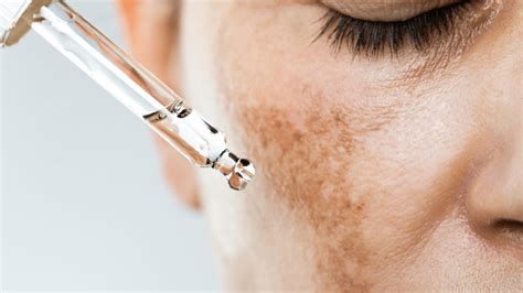 Hiperpigmentação melasma e áreas escuras qual o melhor tratamento de